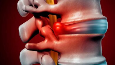 Fıtık Nedir, Belirtileri Nelerdir, Tedavisi Nasıl Yapılır? 7 Fıtık ...